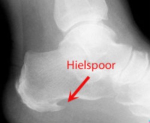 Hielspoor en fasciitis plantaris - AZ Sint-Lucas