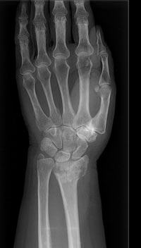 Polsfractuur - Orthopedie - AZ Sint-Lucas